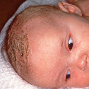 Cradle Cap - Akshar Pediatrics